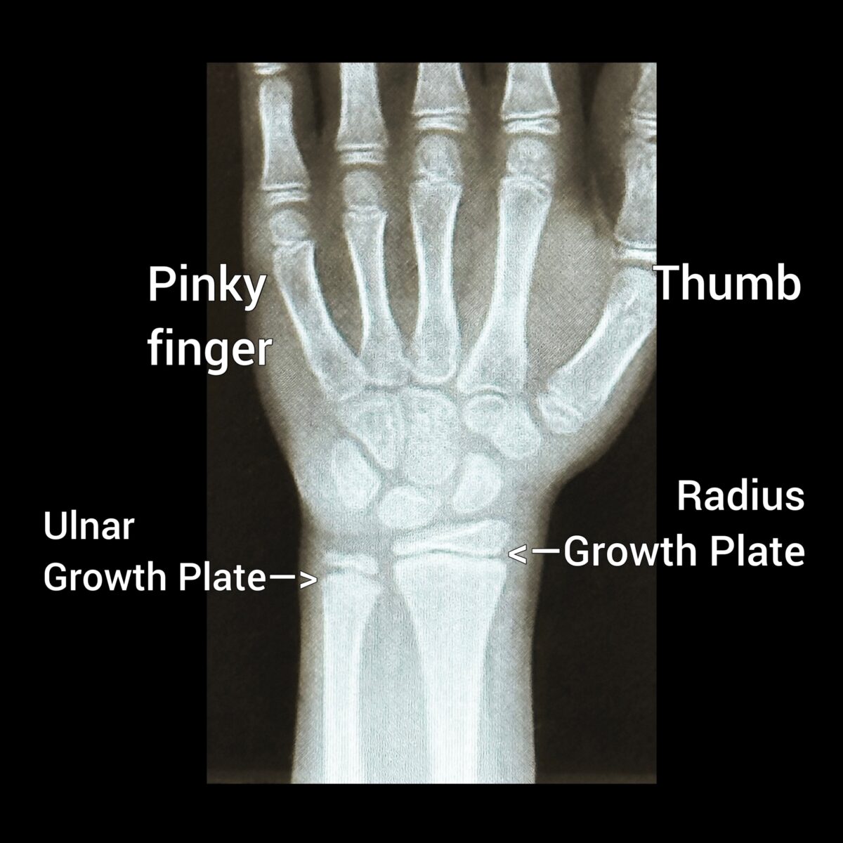 Wrist Injuries - Gymnastics Medicine