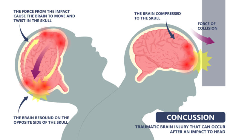 Concussion & Facial Trauma Injuries - Gymnastics Medicine