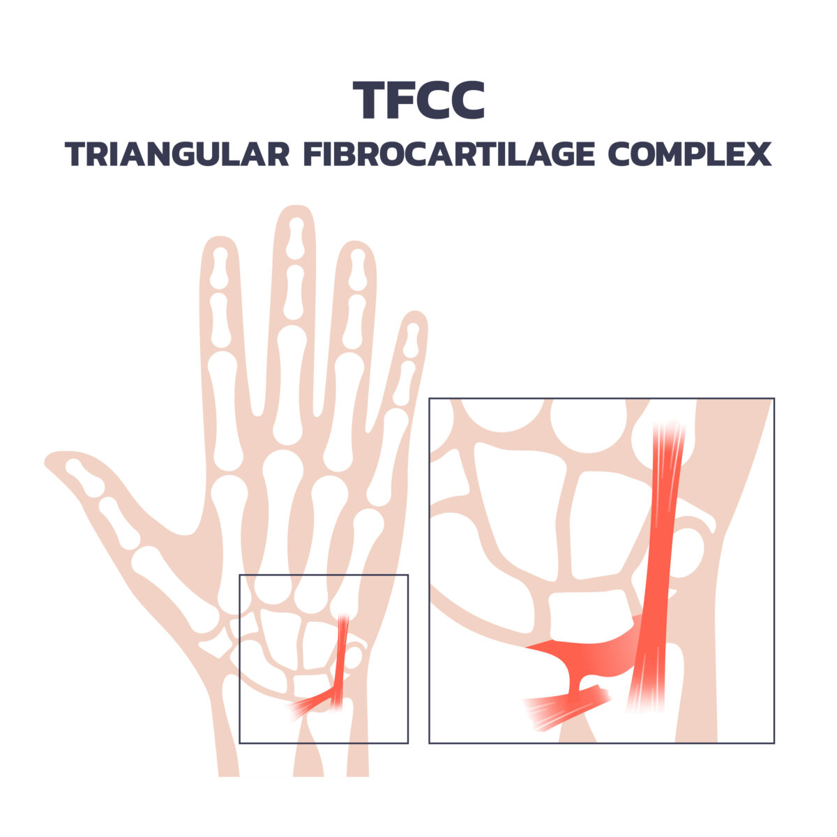 Wrist Injuries - Gymnastics Medicine
